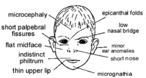 An introduction to Foetal Alcohol Spectrum Disorder (FASD) - Institute ...